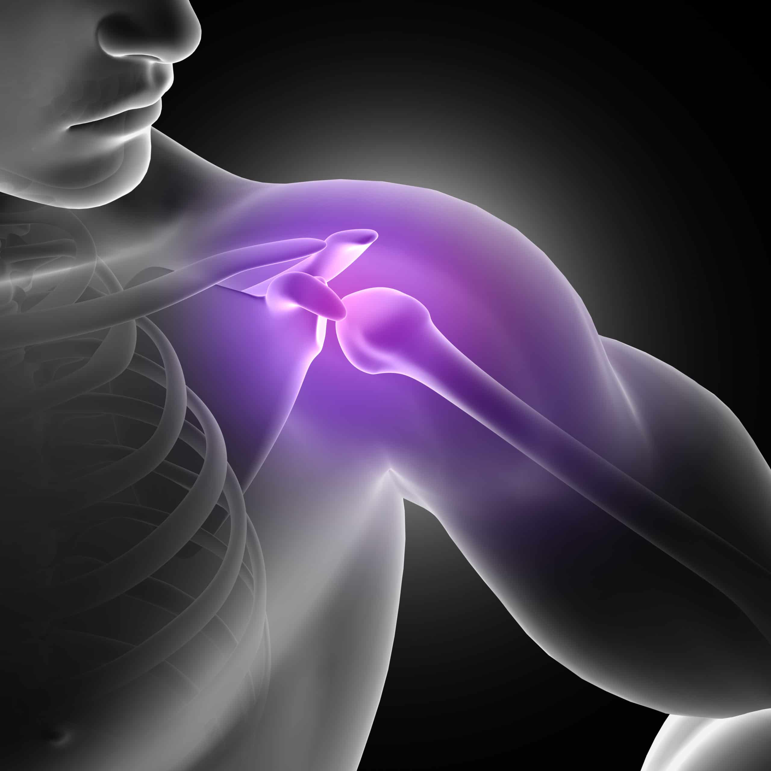 Osteolysis Treatment | Weighlifters Shoulder | Dr. Robert Berry | Dallas